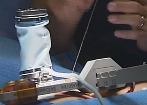 Mazor Robotics sells 11 Renaissance system in Q2 2016 - Israel ...